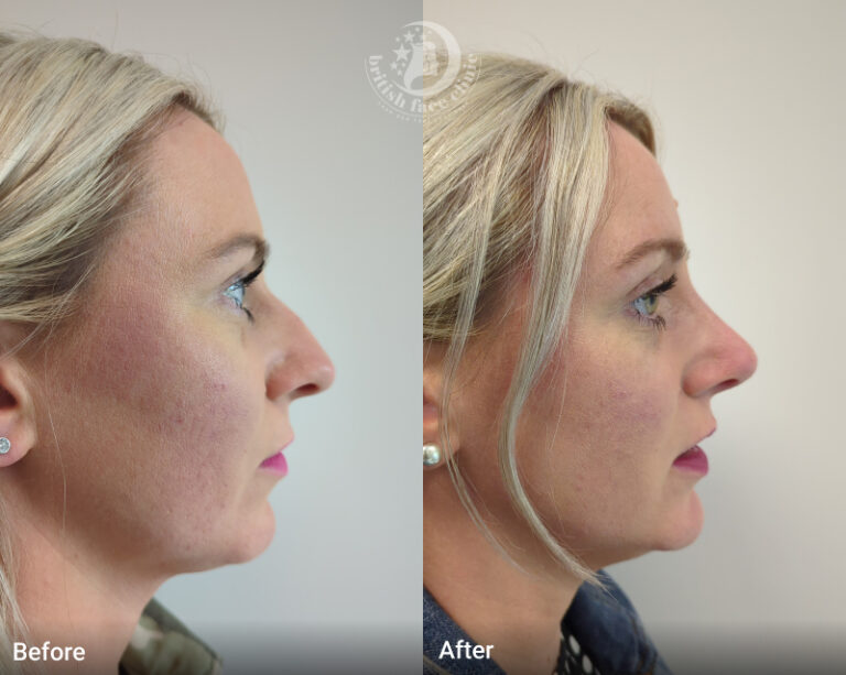 Rhinoplasty Before and After UK | British Face Clinic